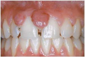 Flashcards - PP6 Diseases of the Gingiva