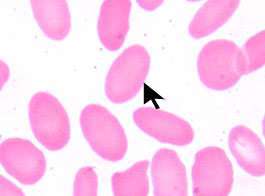 Flashcards - Hematology and Oncology Pathology