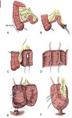 Flashcards - Three14 141 Orthotopic Urinary Diversion