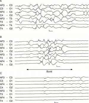 Flashcards - neurophysiology - EEG