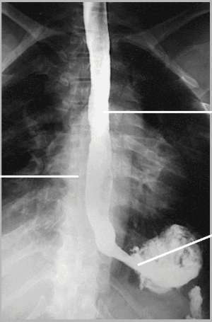 Flashcards - Unit 4 (Upper GI)