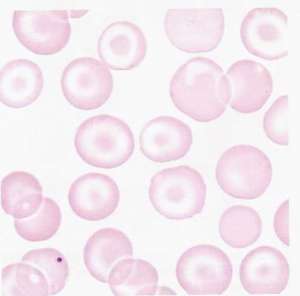 Flashcards - Hematology