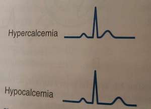 Flashcards - Cardiovascular ECG