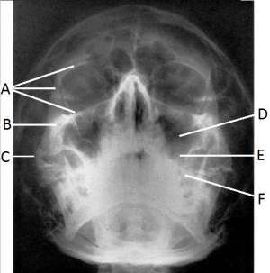 Flashcards - Unit 5 (Facial Bones)