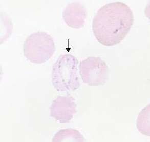 Flashcards - Hematology