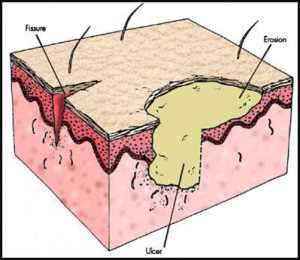 Flashcards - DERM_DESC_LESIONS_MS2