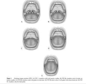 Flashcards - General ENT
