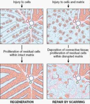 Flashcards - Path Tissue Repair & Regeneration (5)