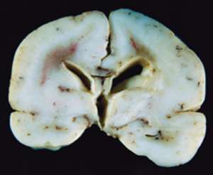 Flashcards - Pathology CNS2