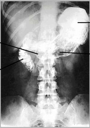 Flashcards - Unit 4 (Upper GI)