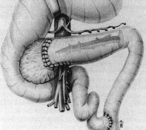 Flashcards - Gastro 55 Pancreatitis