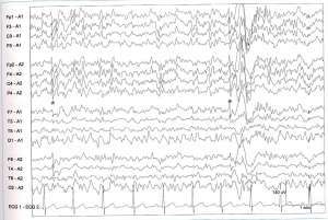 Flashcards - Neurophys - EEG