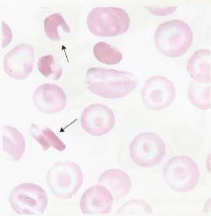 Flashcards - Hematology