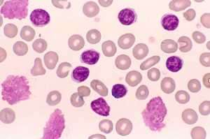 Flashcards - Chronic Lymphocytic Leukemias