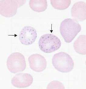 Flashcards - Hematology