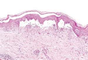 Flashcards - Pathology Images: Acute Inflammation