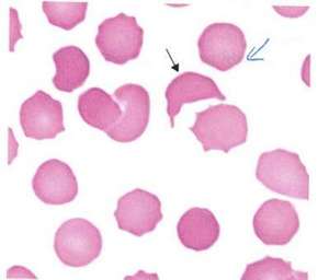 Flashcards - Hematology and Oncology Pathology