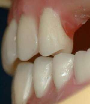 Flashcards - Dentures Lingualized