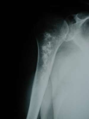 Flashcards - Radiology 2- abnormalities of bone density