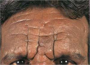 Flashcards - Derm infections Pictures Pt 1