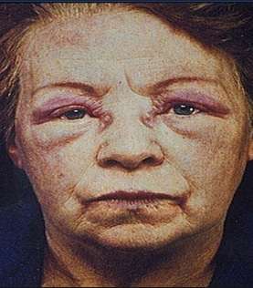 Flashcards - Facies semiologicas