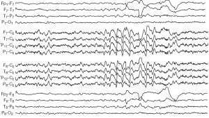 Flashcards - neurophysiology - EEG
